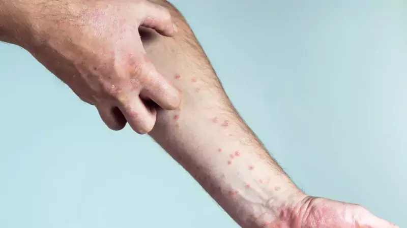 Beriberi: Overview, Causes, and Symptoms