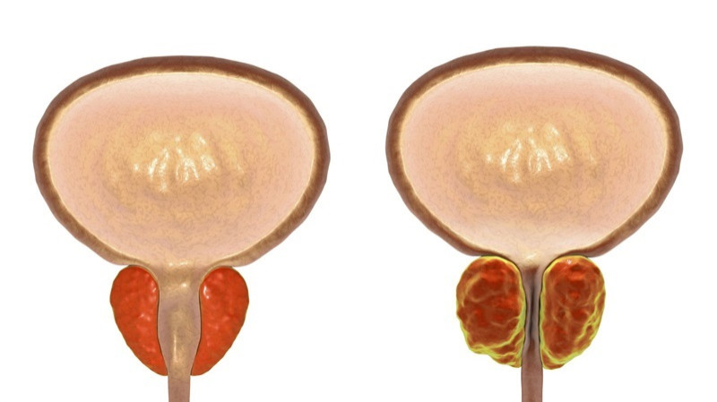 Enlarged Bladder - Causes, Symptoms, and Treatment Options