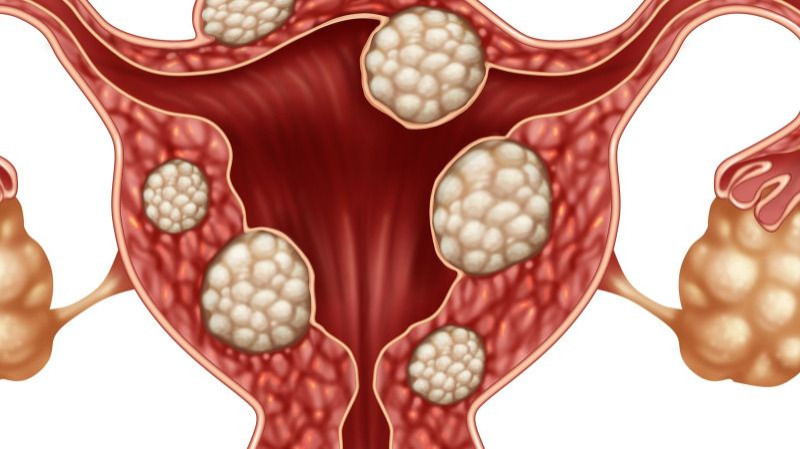 Intramural Fibroid - Causes, Symptoms, and Treatment Options